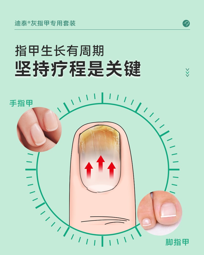 【中国直邮】 太平 乳膏 治疗甲癣特效药膏 适用于真菌感染脚趾甲发黄变厚 12g/盒(灰指甲专用药) | 亚米